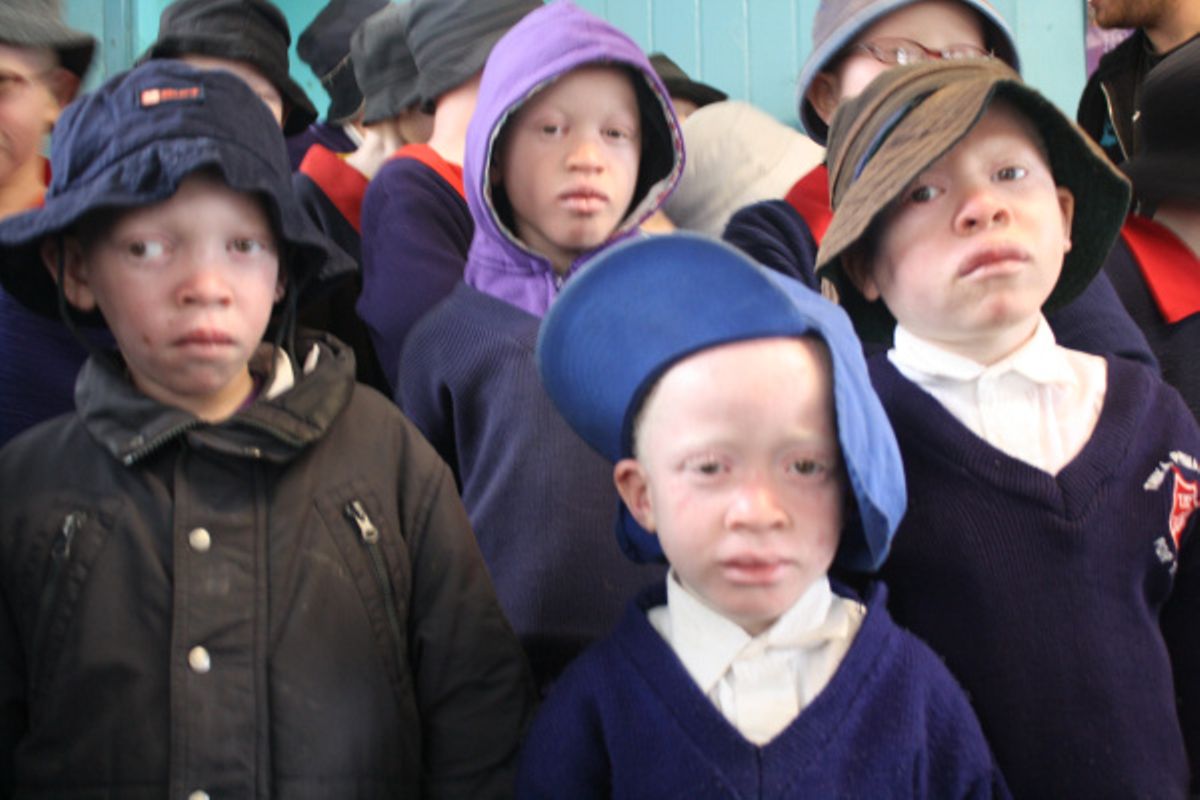 Respect people living with albinism, musician tells locals