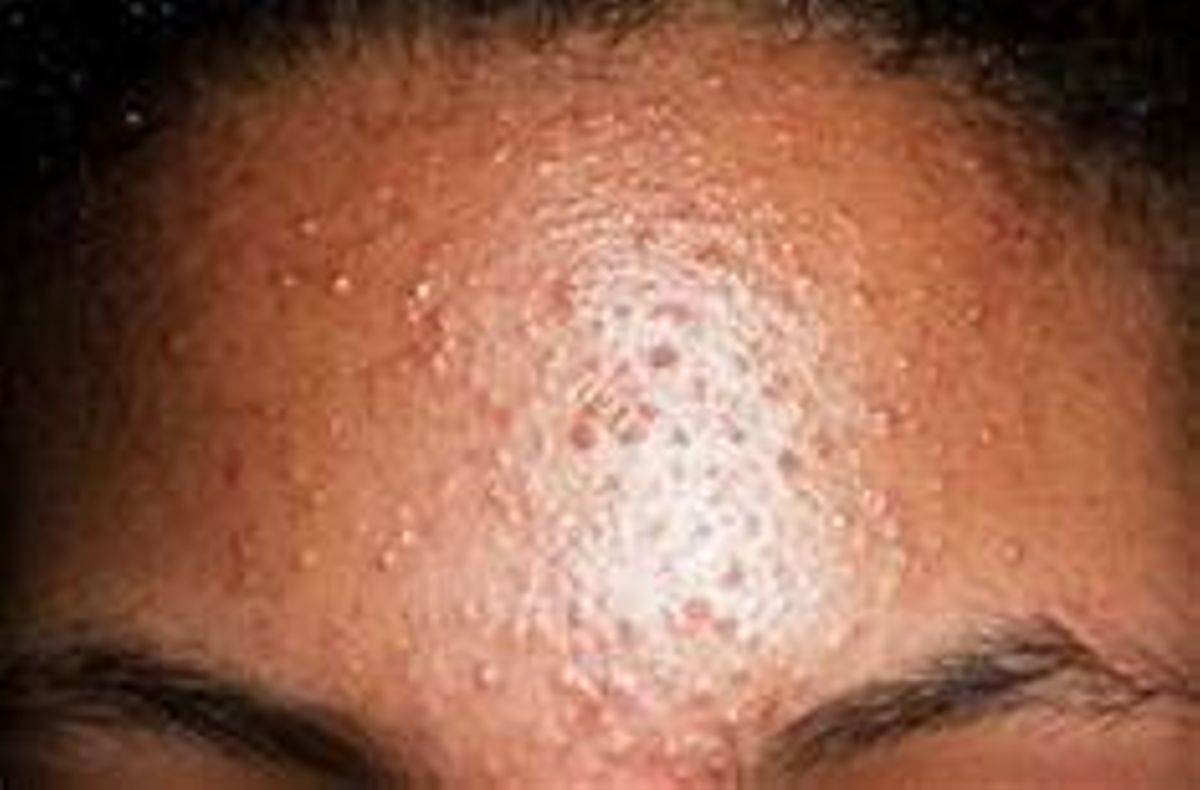 Why pimples appear on your face